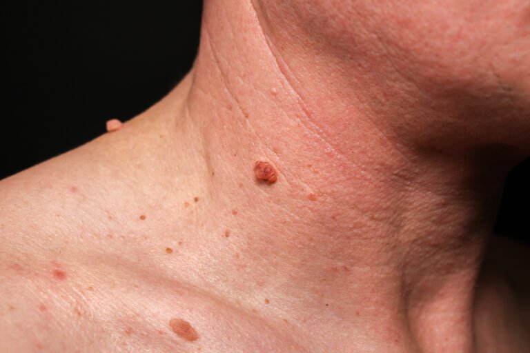 ¿Por qué salen verrugas en el cuello y axilas? - Distribuidores Médicos